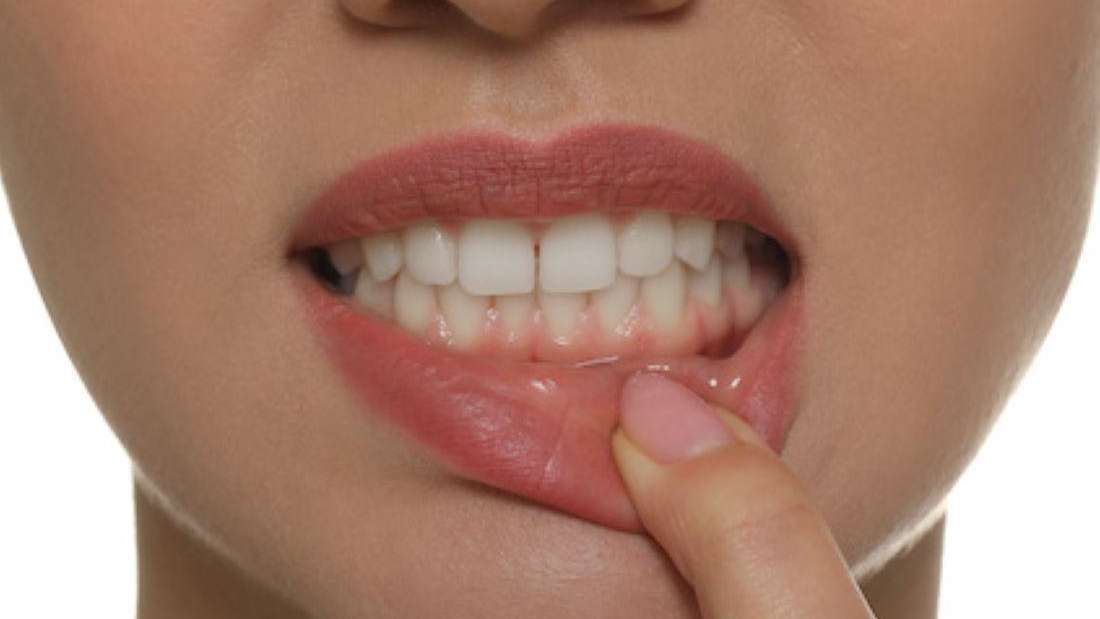 How to Detect and Treat Aggressive Periodontitis | Periodontal ...